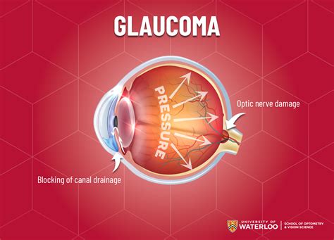Glaucoma Eye Disease World Glaucoma Day 2024 Early Signs Of Eye