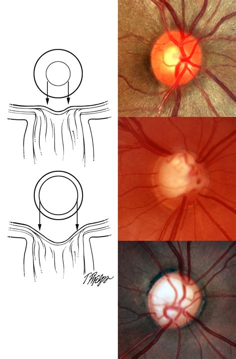 Abnormal Optic Nerve