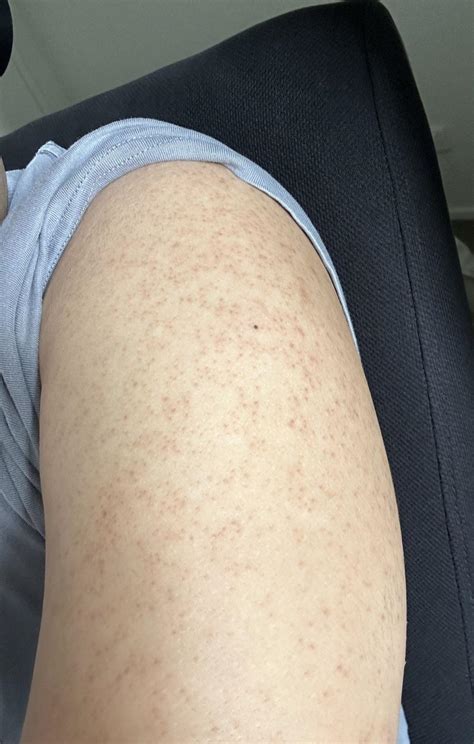 Have These Tiny Reddish Dots On Back And Shoulders For Few Years Now What Is It And Can I Get