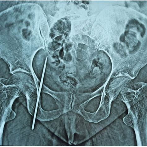 X Ray Pelvis Showing A Linear Radio Opaque Shadow In The Right Hemipelvis Download Scientific