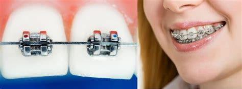 How Do Braces Work Ortho3
