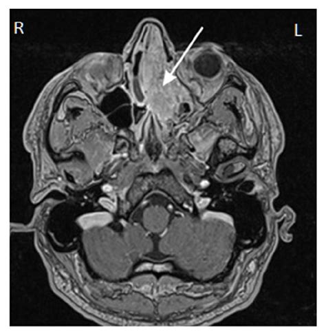 Risk Factors Of Recurrence And Malignant Transformation Of Sinonasal Inverted Papilloma Pmc