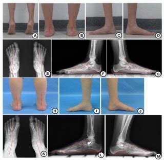 Appearance And X Ray Before And After Operation A Hindfoot Valgus