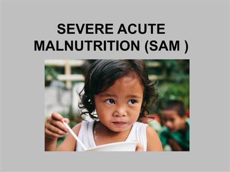 Severe Acute Malnutrition Pediatricspptx