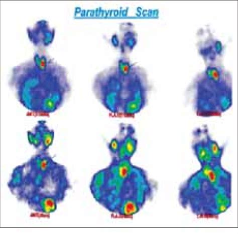 Parathyroid Scintigraphy Study Of The Patient Showing Parathyroid
