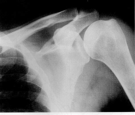 3 Shoulder Radiology I Images Only Flashcards Quizlet