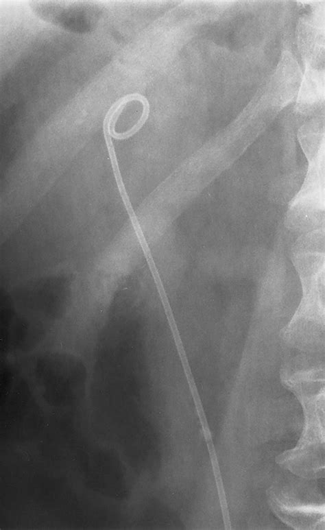 Complications Of Ureteral Stent Placement Radiographics