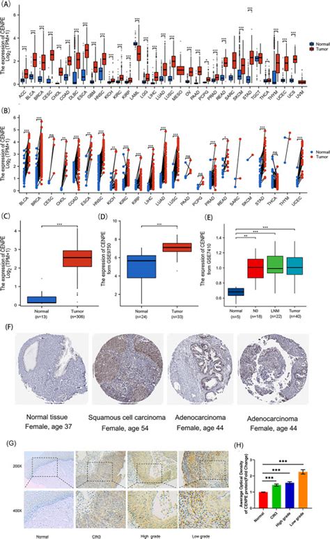 Cenpe Is A Diagnostic And Prognostic Biomarker For Cervical Cancer Heliyon