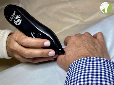 Microcurrent Therapy Acuangel Microcurrent Therapy Acuangel