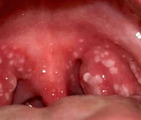 Common Strep Throat Symptoms You Should Know Credihealth