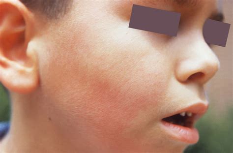 Hand Foot And Mouth Disease Causes Symptoms And Treatment Cnn