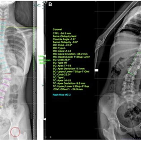 13 Years Old Female Sanders 5 With A A Major Thoracic Curve 52° B Download Scientific