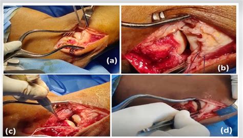 Surgical Exposure Of Lesion And Debridement A Kochers Lateral Download Scientific Diagram