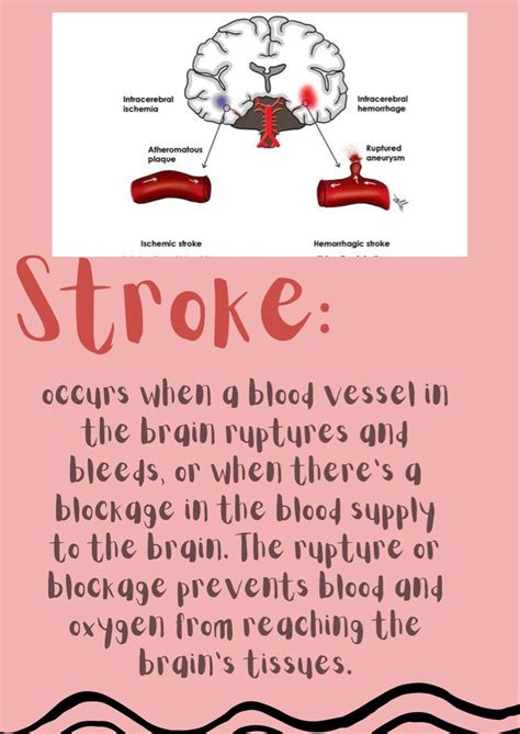 Cerebellar Stroke And Vertebral Artery Dissection Home Is Where My