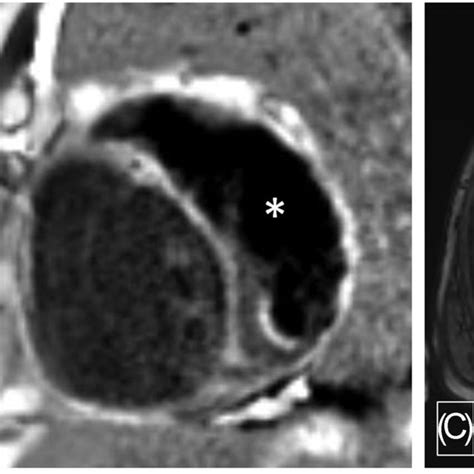 First Pass Perfusion Image A Shows No Significant Enhancement Within