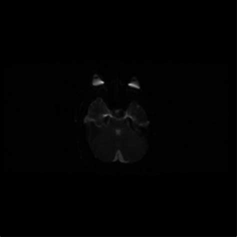 Choroid Plexus Papilloma Radiopaedia 34951 36441 Axial Dwi Nc Commons
