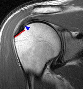 Supraspinatus Tear Mri