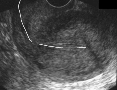 Retroverted Uterus Transabdominal Ultrasound