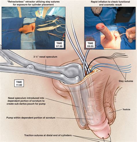 Pump Penile Implant Surgery