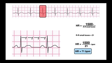 Determine HR From A Regular Rhythm EKG 1500 300 Methods YouTube