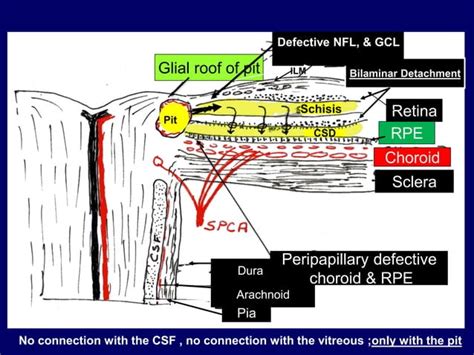 Optic Disc Pit Pathogenesis And Management Ppt Eye And Vision Conditions Diseases And