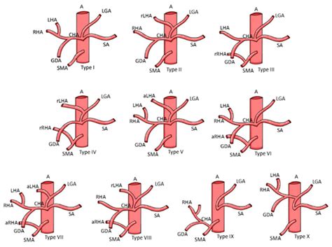 Classification Of Hepatic Artery Anatomy Variation According To Michels