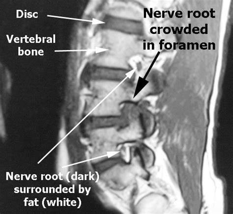 Foraminal Stenosis Mri Cervical Foraminal Stenosis Causes And