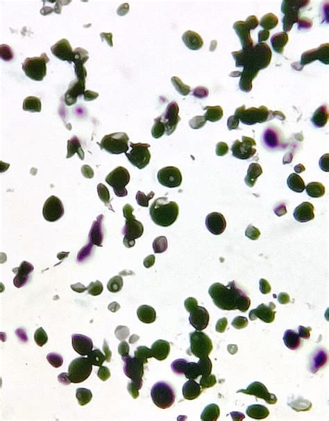 Cryptococcus Abdominal Ln Gms Stain