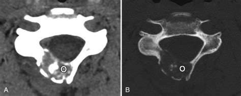 Osteochondroma Radiology Key