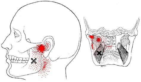 Pterygoid Muscle Pain And Trigger Points