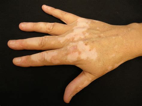 Hypopigmented Macules Treatment And Management Point Of Care