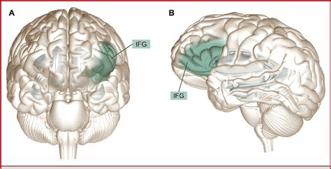 Figure 5 From A Review Of Cortical And Subcortical Stimulation Mapping For Language Semantic