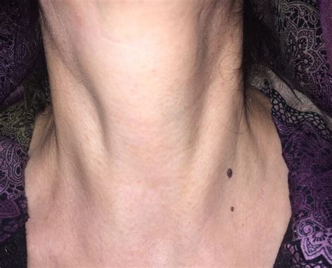 What Is Thyroid Cancer Prof Dr Nilda Sütay Süslü