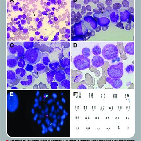 Comparison Of The Findings Between Apl Patients And Patients With Other Download Scientific