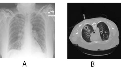 Ap Chest X Ray Showing Multiple Ill Defined Nodular Densities In The Download Scientific