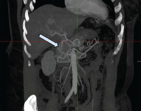 Median Arcuate Ligament Syndrome Incidental Finding Or Real Problem