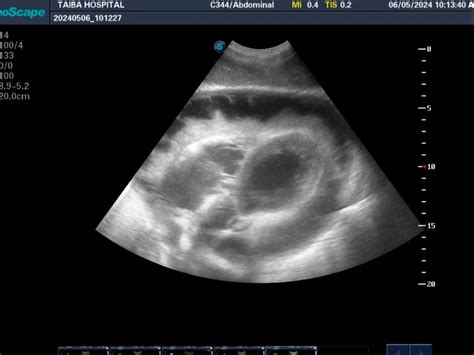 Muthab Suliman On Linkedin Case Number 1️⃣ ∆ Subxiphoid View Using