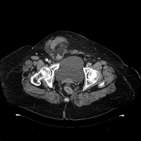Radiopaedia Case Incarcerated Inguinal Hernia With Bowel Perforation Id