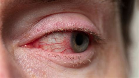 What Is Demodex And Blepharitis Lash Resource