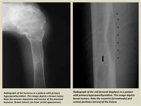 Hyperparathyroidism New