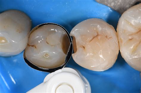 Matrix In Matrix Back To Back Class Ii Matrix In Matrix Back To Back Class Ii