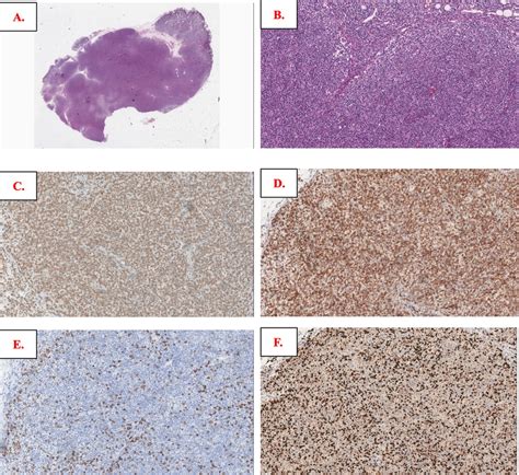 Morphologic And Immunophenotypic Findings From The October 2018