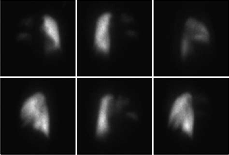 Perfusion Ventilation Scintigraphy Showing Segmental Perfusion Defects