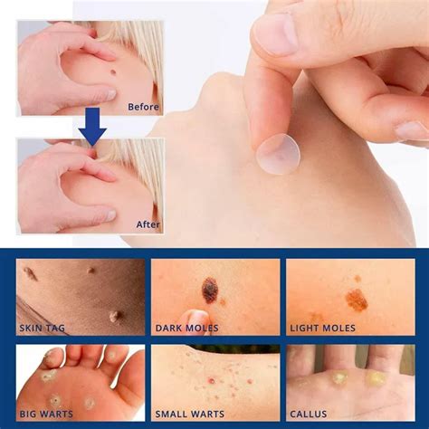 Hold Live Skin Tag Removal 144pcs Skin Tag Remover Patch Warts Remover