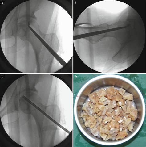 Impaction Bone Grafting Radiology Key