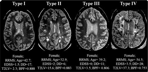 Representative Proton Density Mri Scans Showing The Mri Defined