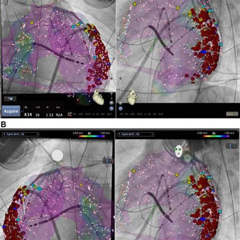 Example Of 3d Electroanatomic Mapping Using The Cartounivu System Download Scientific Diagram