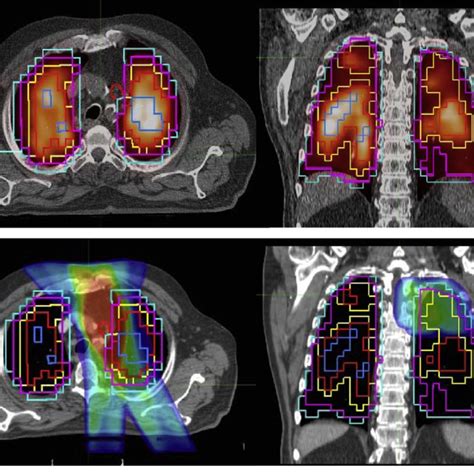 Perfusion Spectct Segmented To Functional Lung Fl 20 80 Of The