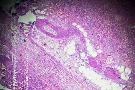 Acute Phlegmonous Appendicitis Pathology Under Light Microscopy Stock