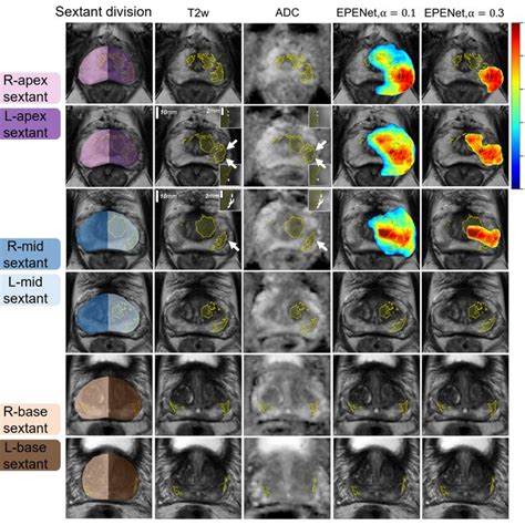 Epenet Predictions For Cancers With Extraprostatic Extension In One Download Scientific Diagram